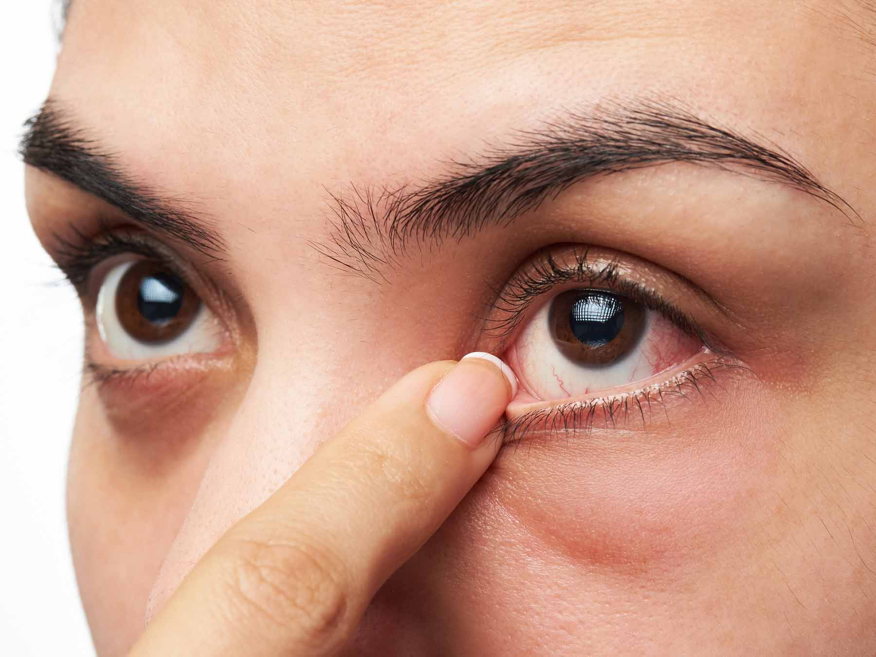 Kako si pomagati pri tujku v očesu | Očesni center Morela d.o.o.