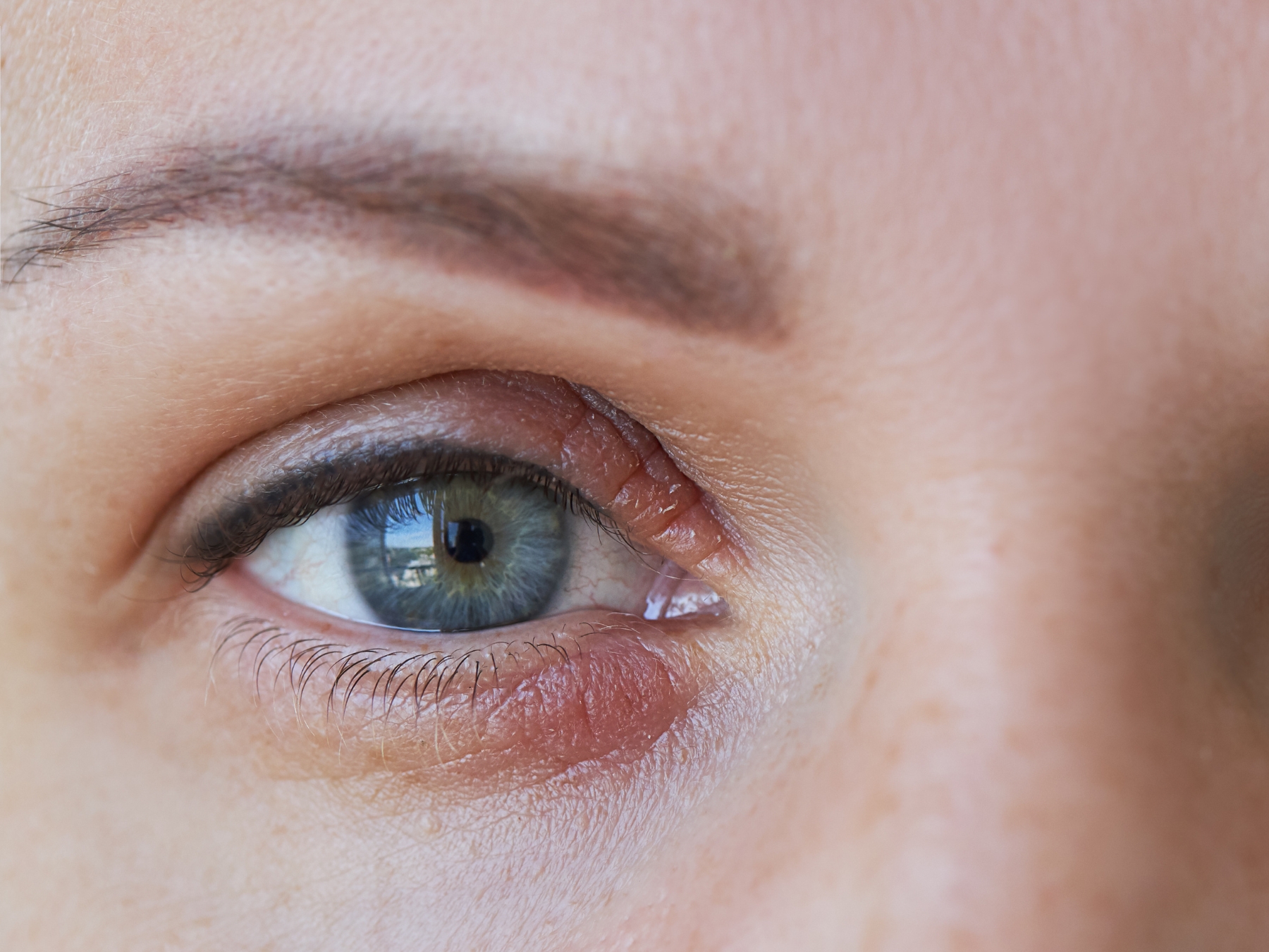 Blefaritis | Očesni center Morela